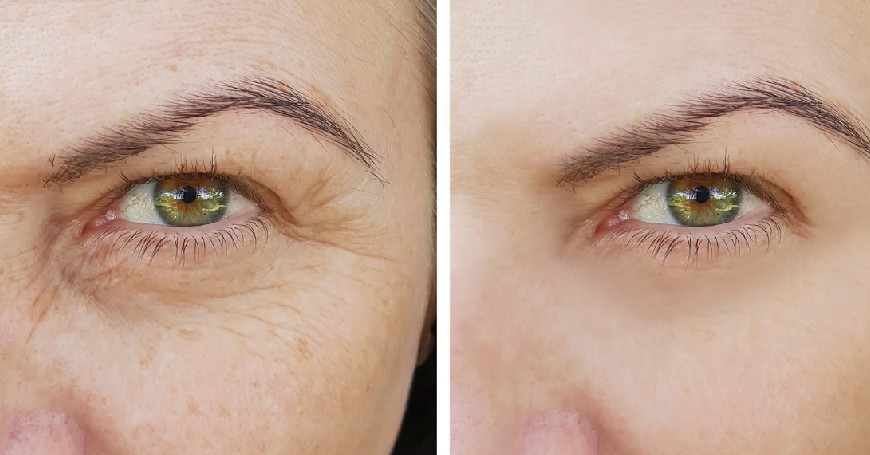 Filler Viso Prima e Dopo