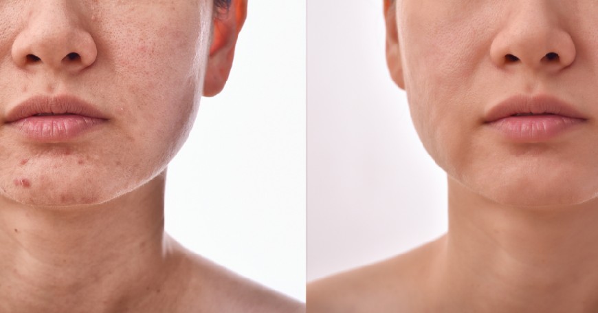 Filler Viso Prima e Dopo